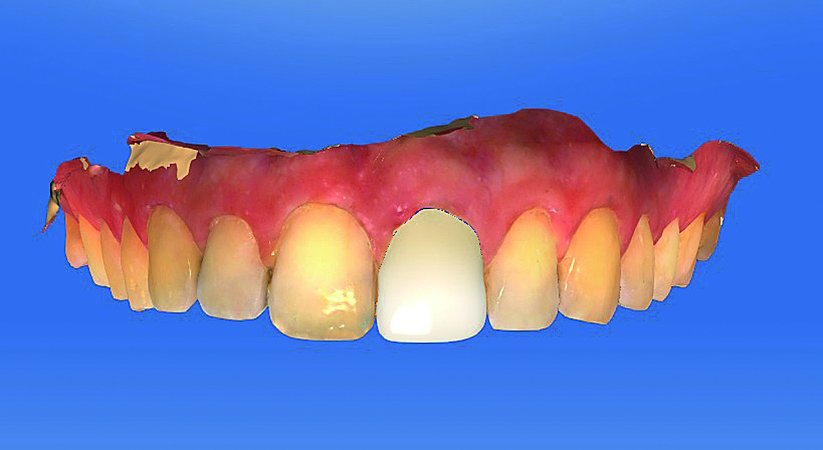 Dental News - Fast, functional aesthetic solution for anterior tooth trauma