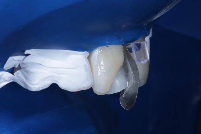 Bringing anterior direct composite restorations to life with histologic ...