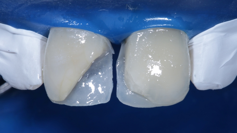 Bringing anterior direct composite restorations to life with histologic ...