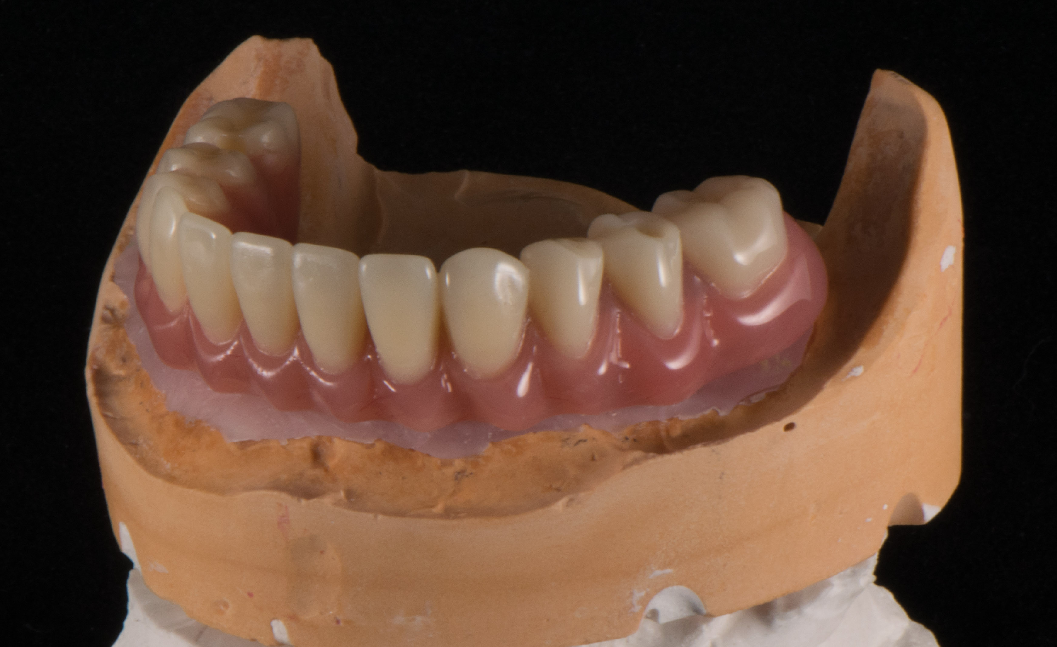 Dental News - Straumann Pro Arch concept with fully guided implant and ...