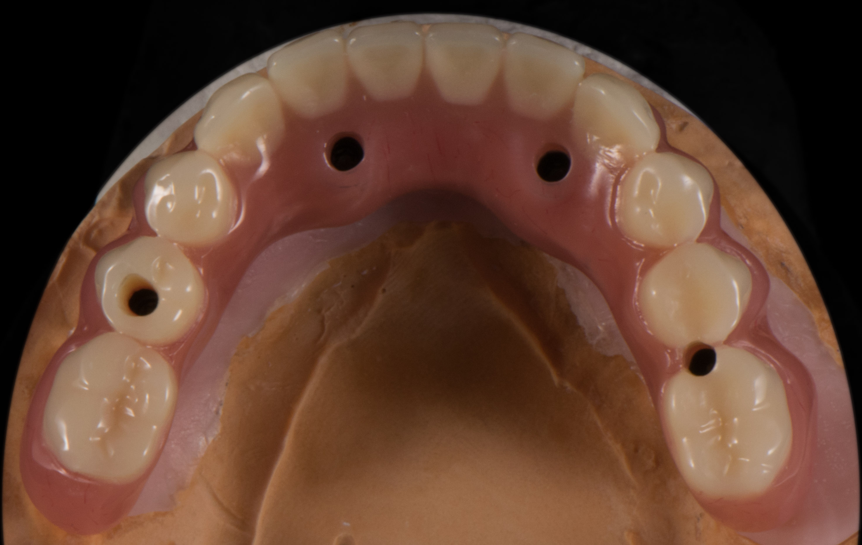 Dental News - Straumann Pro Arch concept with fully guided implant and ...
