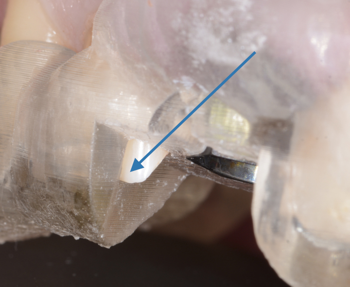 The use of new technologies and digital implant solutions in a one ...