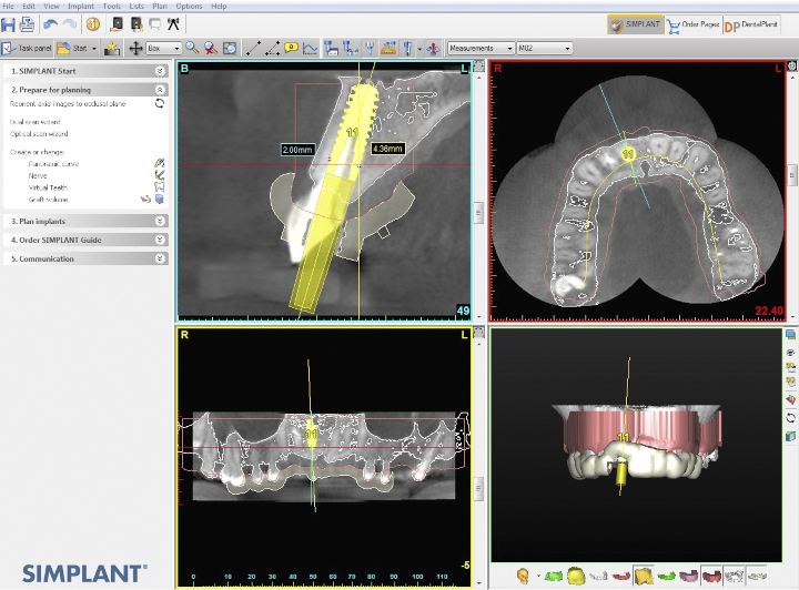 The use of new technologies and digital implant solutions in a one ...