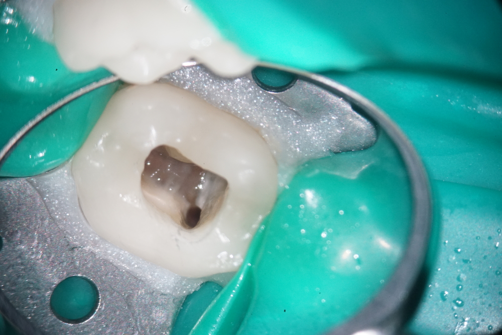 Dental News - Retreatment of a carrier-based root filling with ...